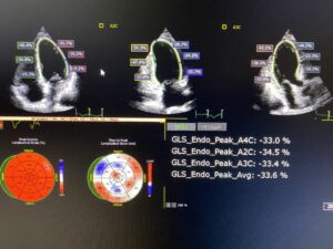 Ecocardiograma com Strain - Clinicor Busato